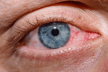 Eyes on Drugs: How to Spot the Signs | Avenues Recovery