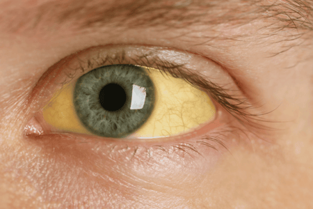 Eyes on Drugs: How to Spot the Signs | Avenues Recovery